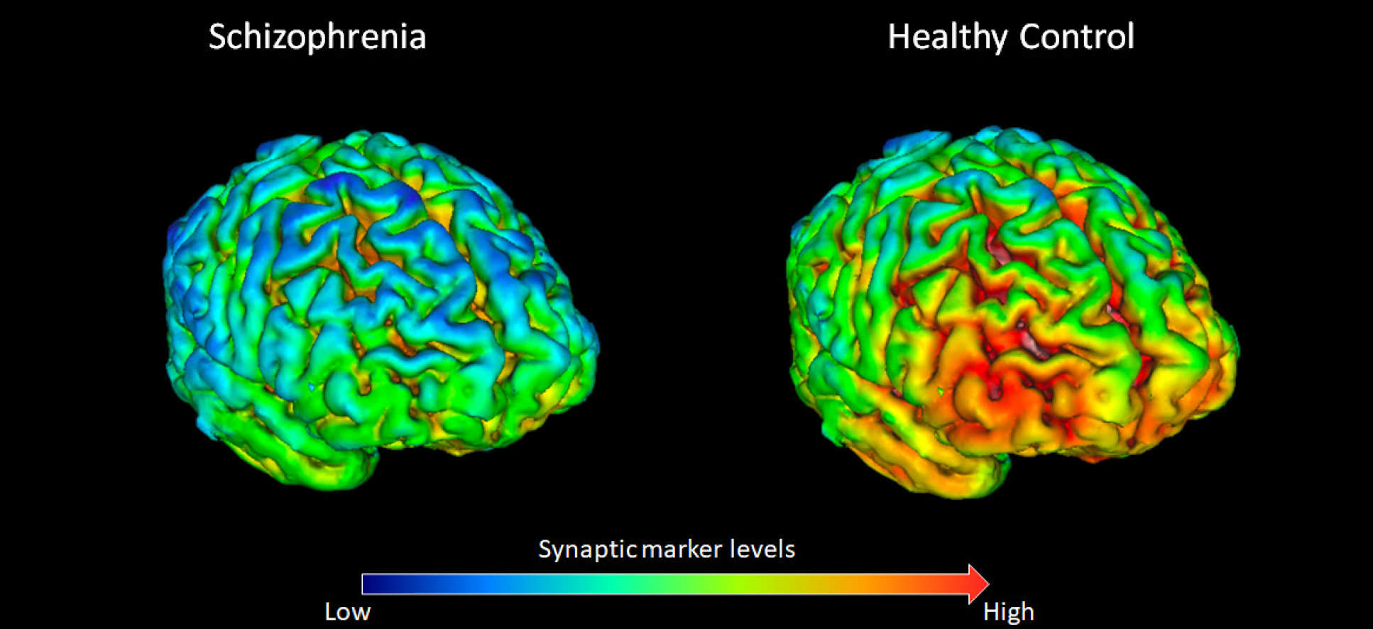 Lack of key protein reduces brain connections in schizophrenia ...